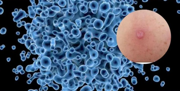 Brotes del virus de Alaska despiertan inquietud en Estados Unidos ...